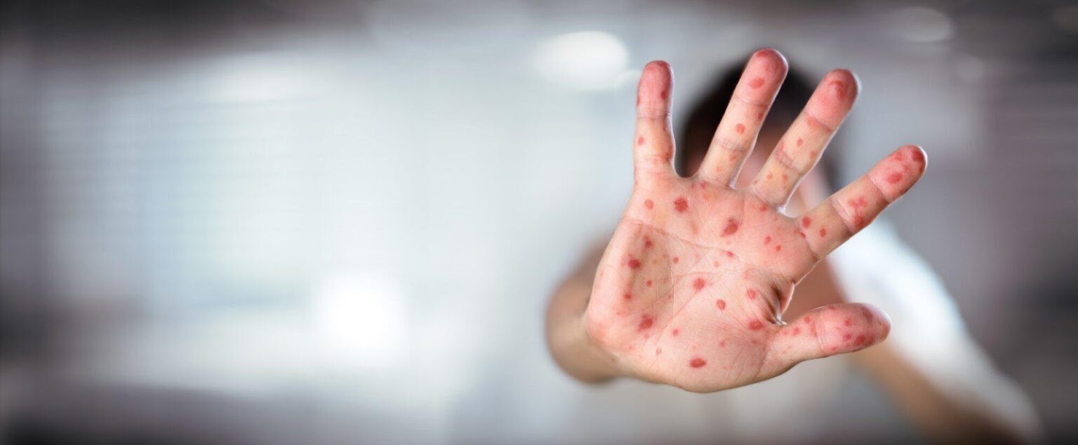 Chickenpox Vs Hand Foot Mouth: A Comparison